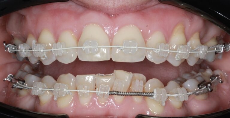 The Ultimate Guide to Braces: Types, Costs, and What to Expect ...